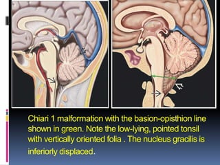 imaging of the craniovertebral junction | PPTX