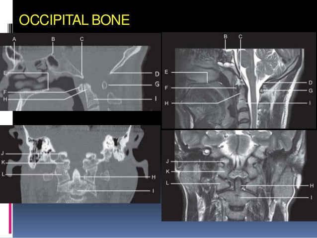 imaging of the craniovertebral junction