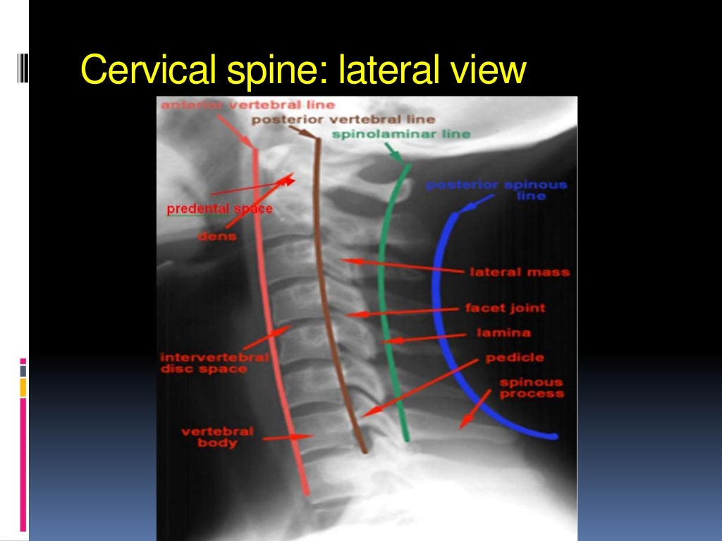 imaging of the craniovertebral junction