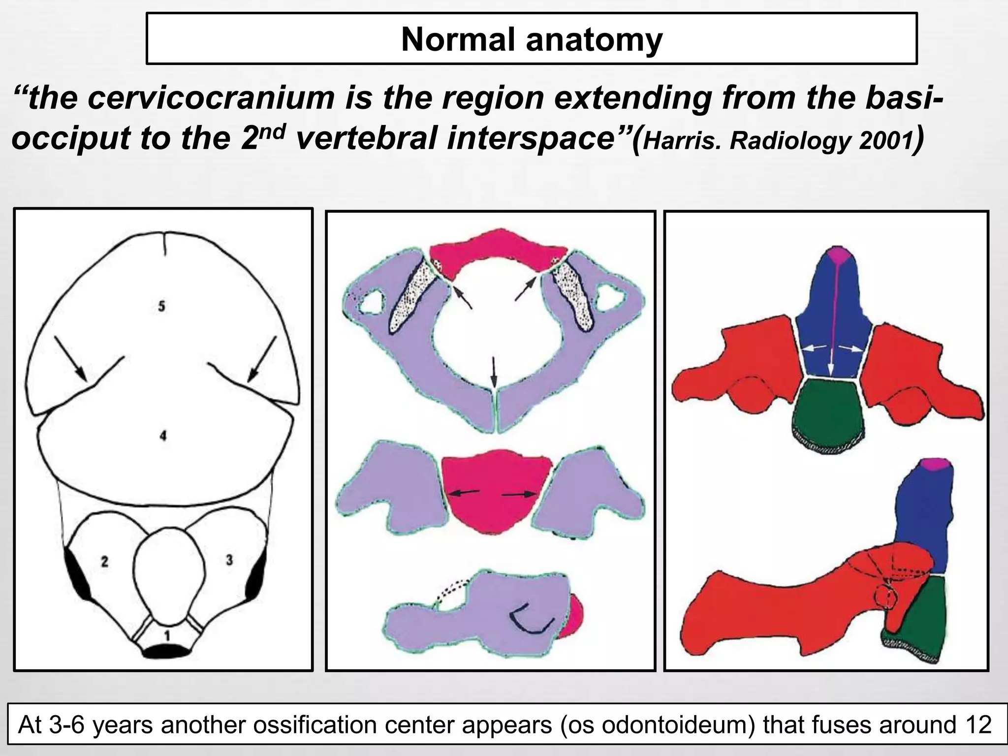 Instability of the cranio-vertebral junction (CVJ) | PPTX