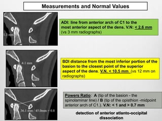 Instability of the cranio-vertebral junction (CVJ) | PPTX