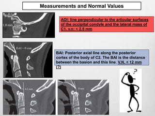 Instability of the cranio-vertebral junction (CVJ) | PPTX | Death ...