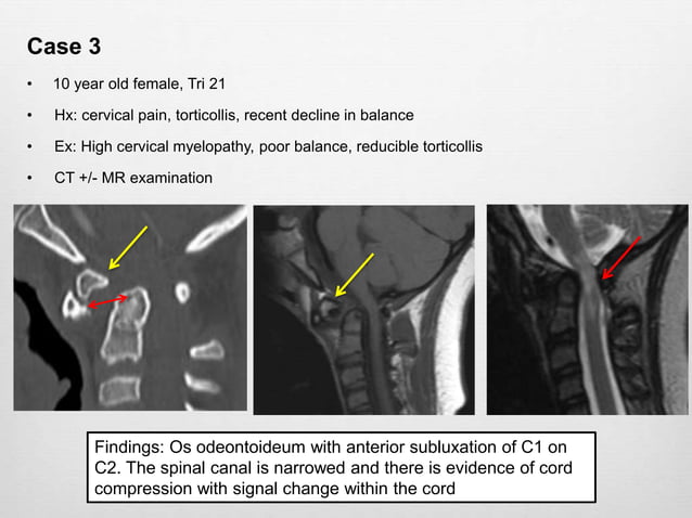 Instability of the cranio-vertebral junction (CVJ) | PPTX | Death ...