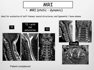 Instability of the cranio-vertebral junction (CVJ) | PPTX