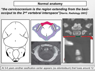 Instability of the cranio-vertebral junction (CVJ) | PPTX