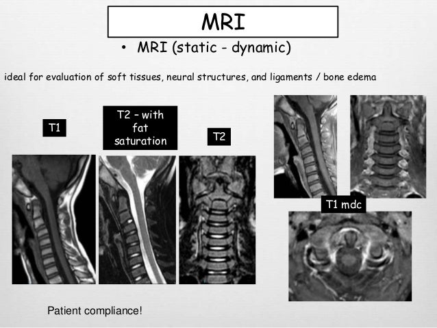 Instability of the cranio-vertebral junction (CVJ)