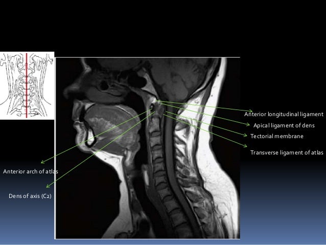 Nuchal Ligament Mri