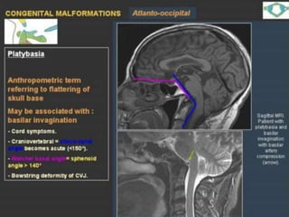 Cv junction anomalies | PPTX
