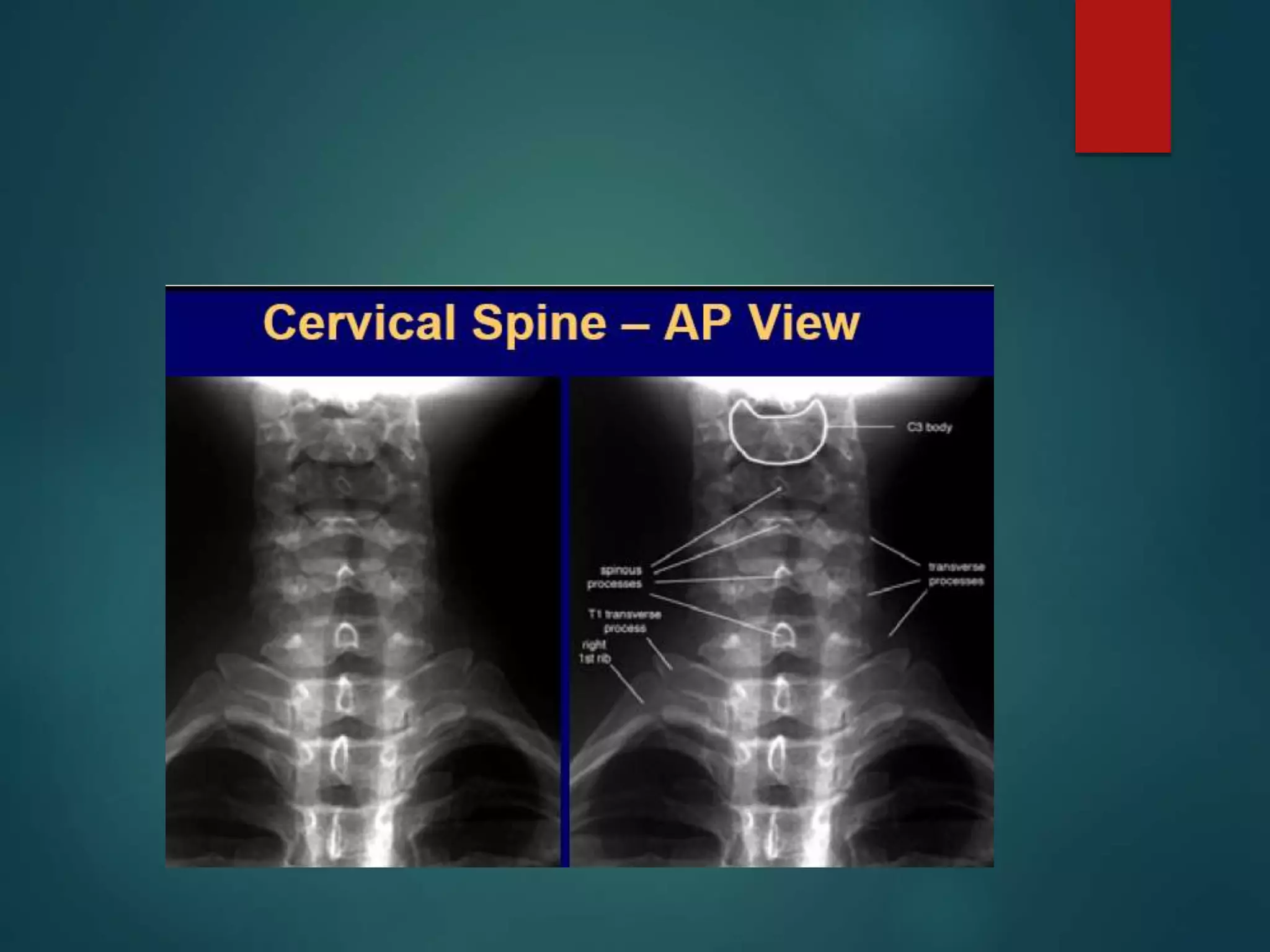 CRANIOVERTEBRAL JUNCTION ANATOMY, CRANIOMETRY, ANAMOLIES AND RADIOLOGY ...