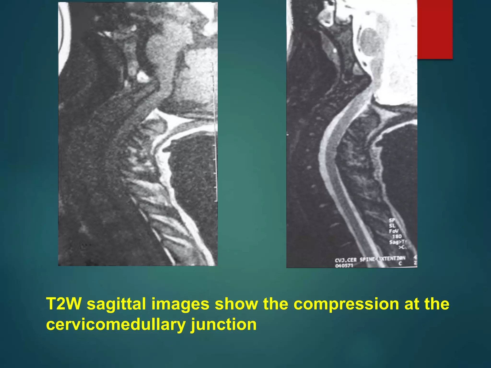 CRANIOVERTEBRAL JUNCTION ANATOMY, CRANIOMETRY, ANAMOLIES AND RADIOLOGY ...