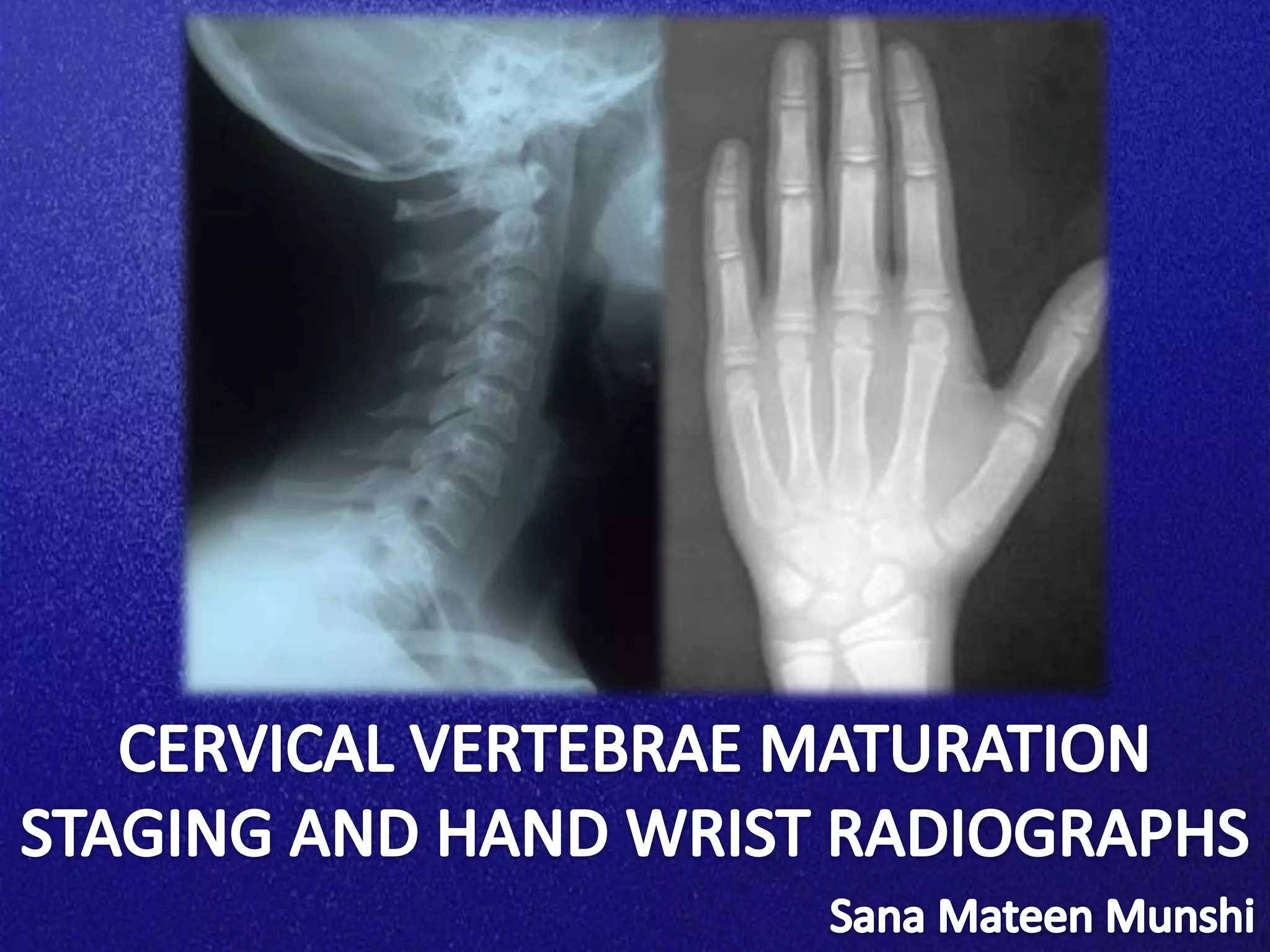 CVM staging and handwrist radiographs | PPTX