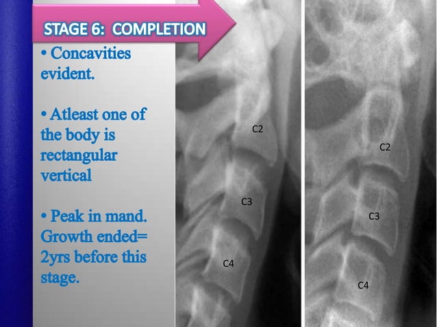 CVM staging and handwrist radiographs | PPTX | Bone and Joint ...