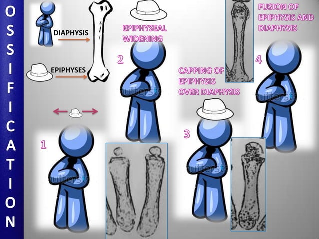 CVM staging and handwrist radiographs | PPTX | Bone and Joint ...