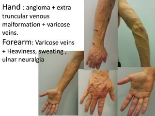 Cvm upper extremity | PPTX