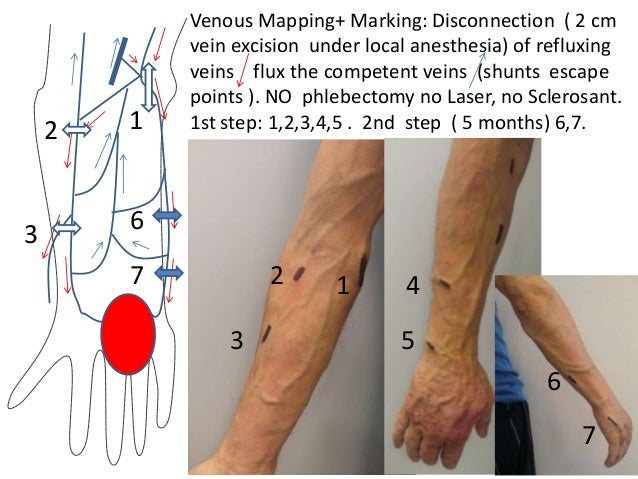 Cvm upper extremity