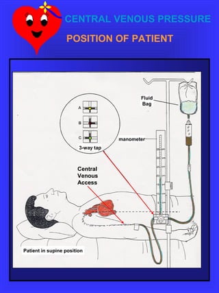 Measuring Central Venous Pressure
