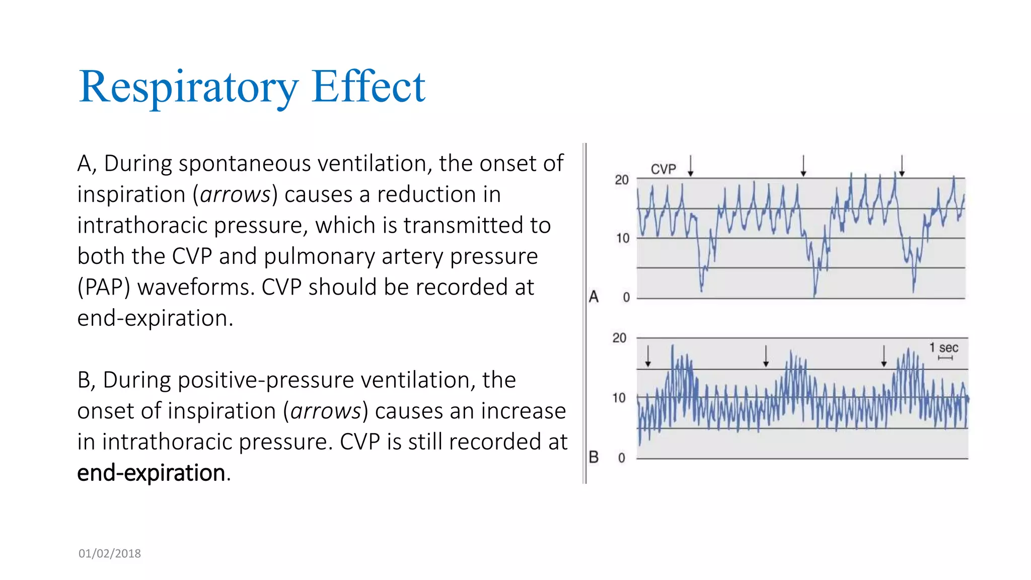 CENTRAL VENOUS PRESSURE MONITORING- IACTACON 2018 | PPTX