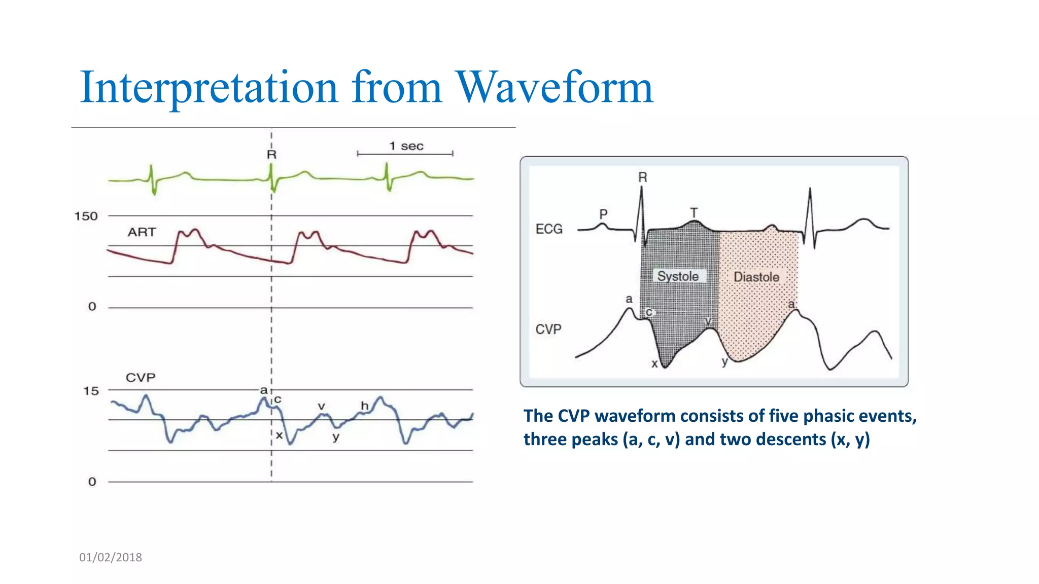 CENTRAL VENOUS PRESSURE MONITORING- IACTACON 2018 | PPTX