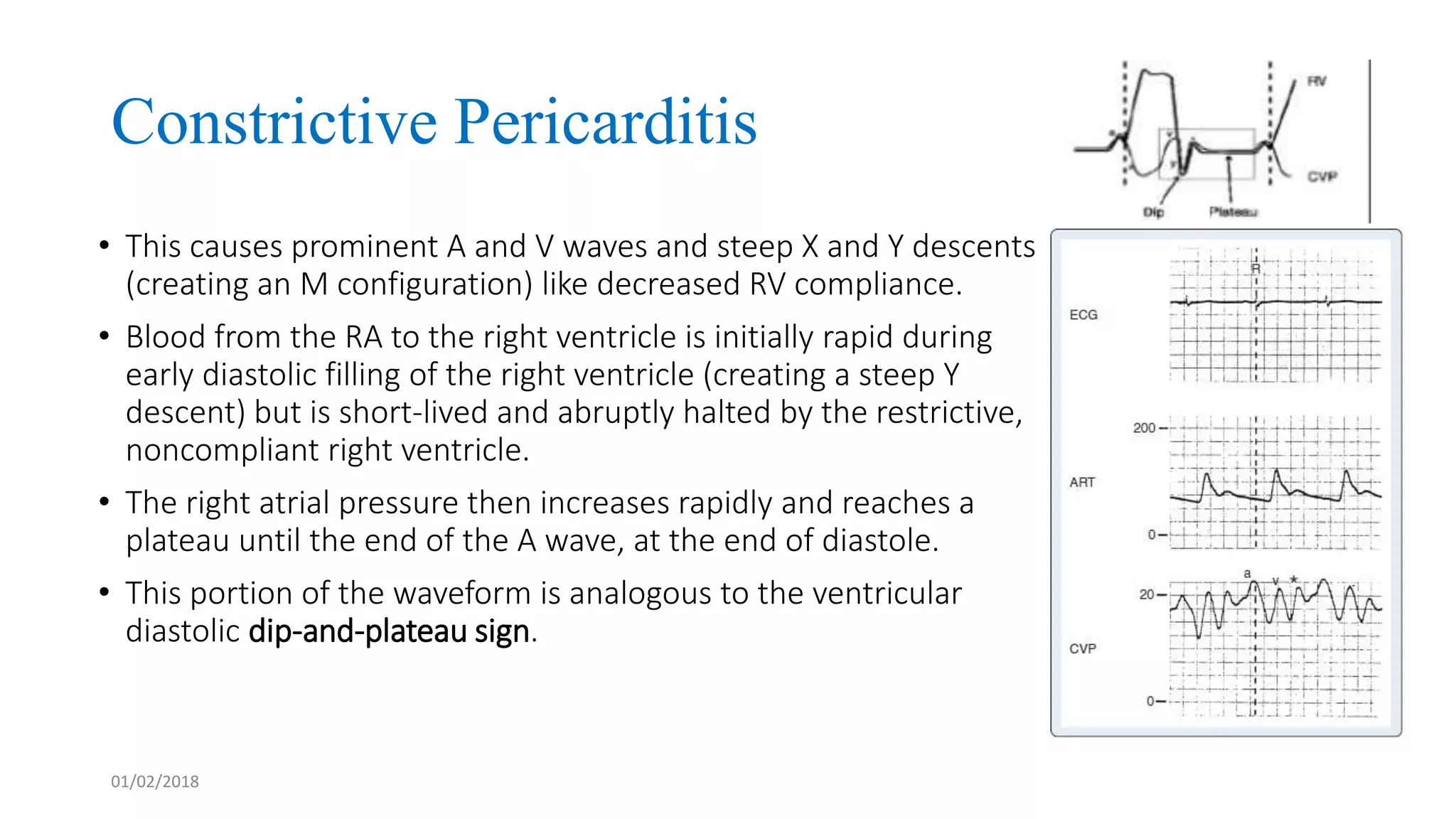 CENTRAL VENOUS PRESSURE MONITORING- IACTACON 2018 | PPTX