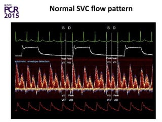 EuroPCR CV pipeline, Kovarnik | PPT