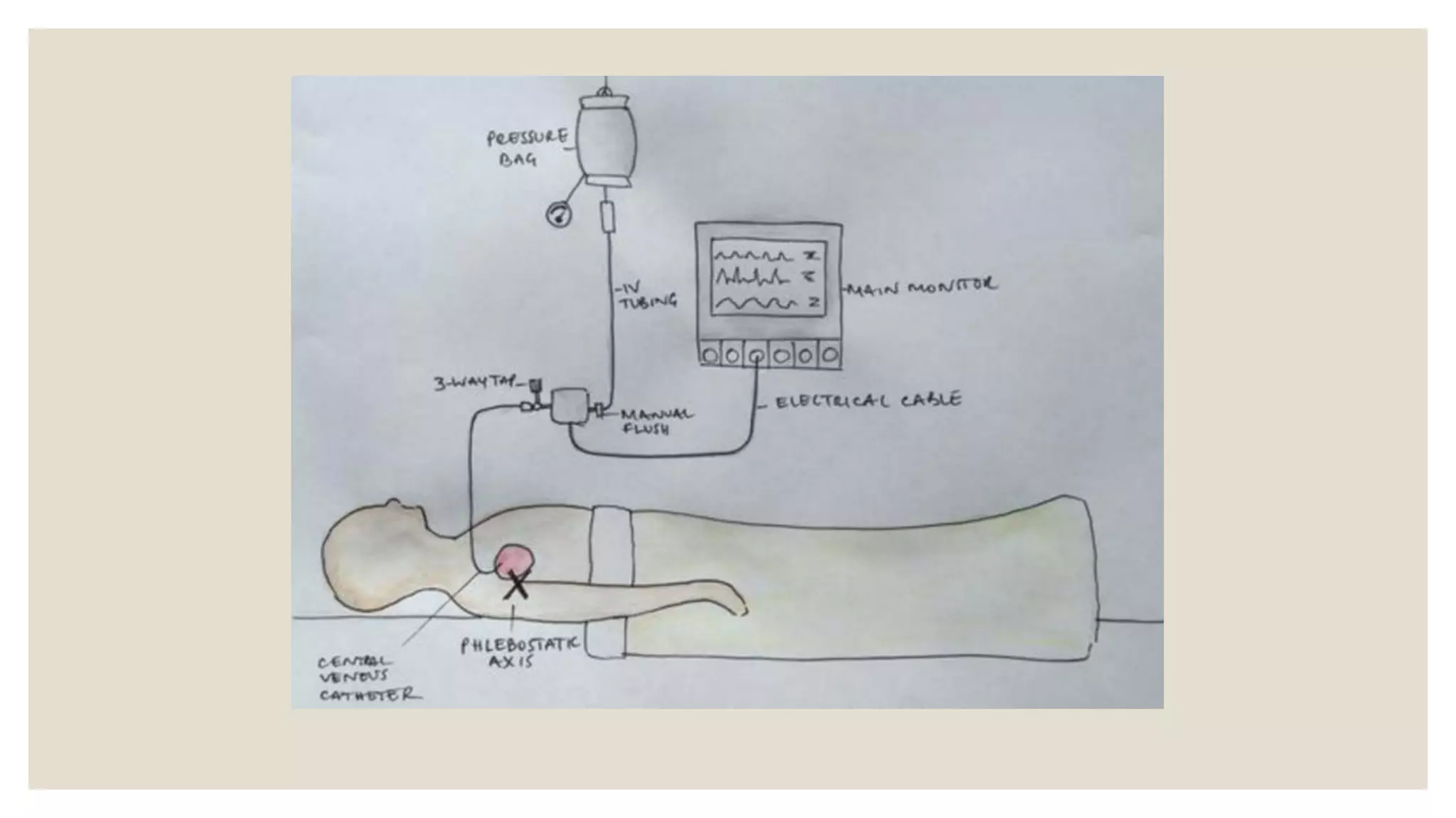 cvp monitoring | PDF