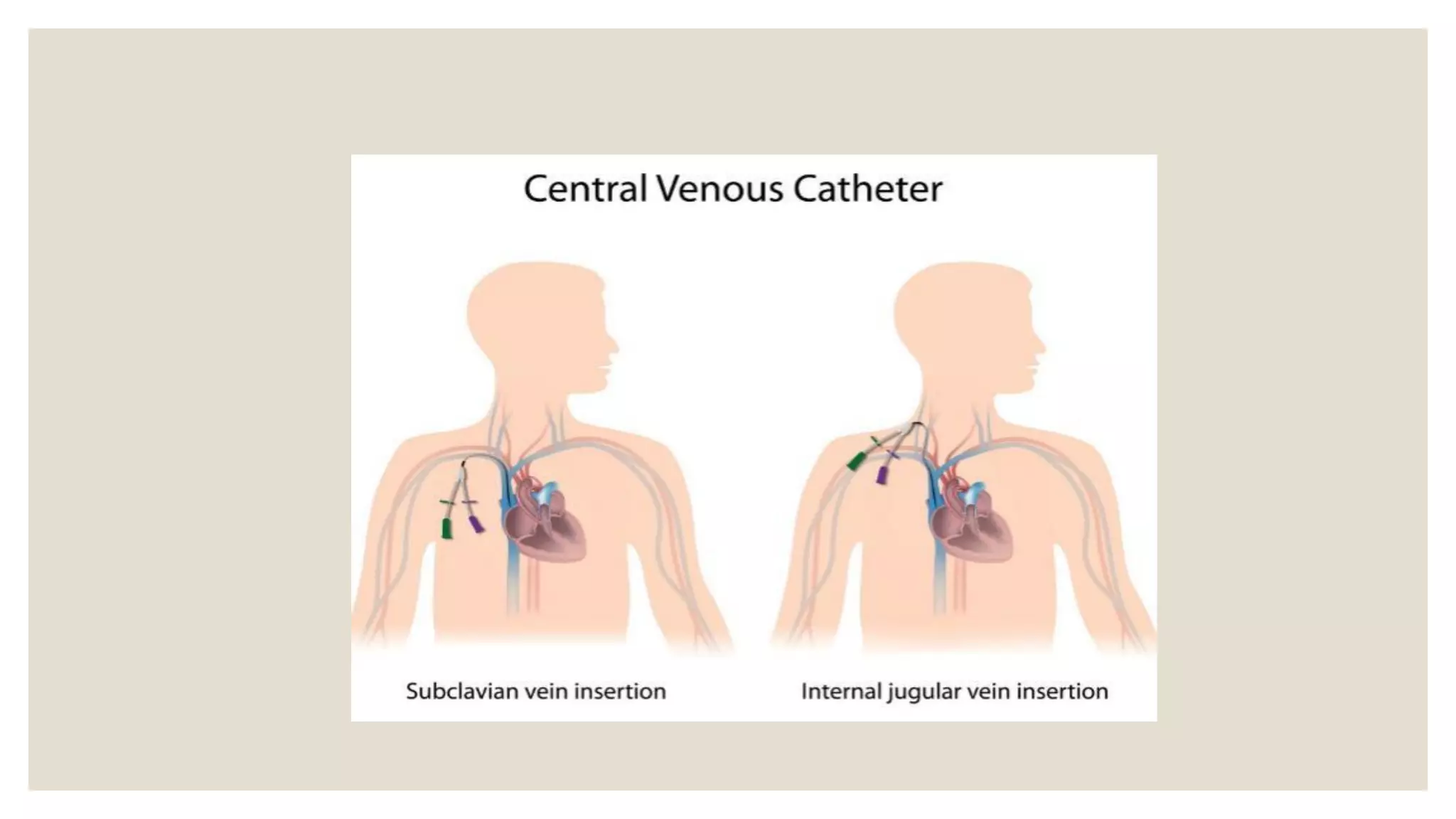 cvp monitoring | PDF