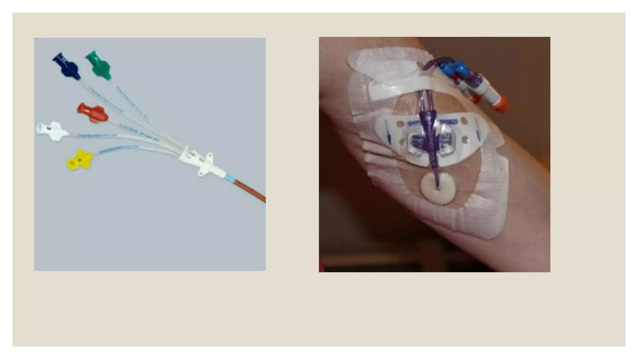 cvp monitoring | PDF