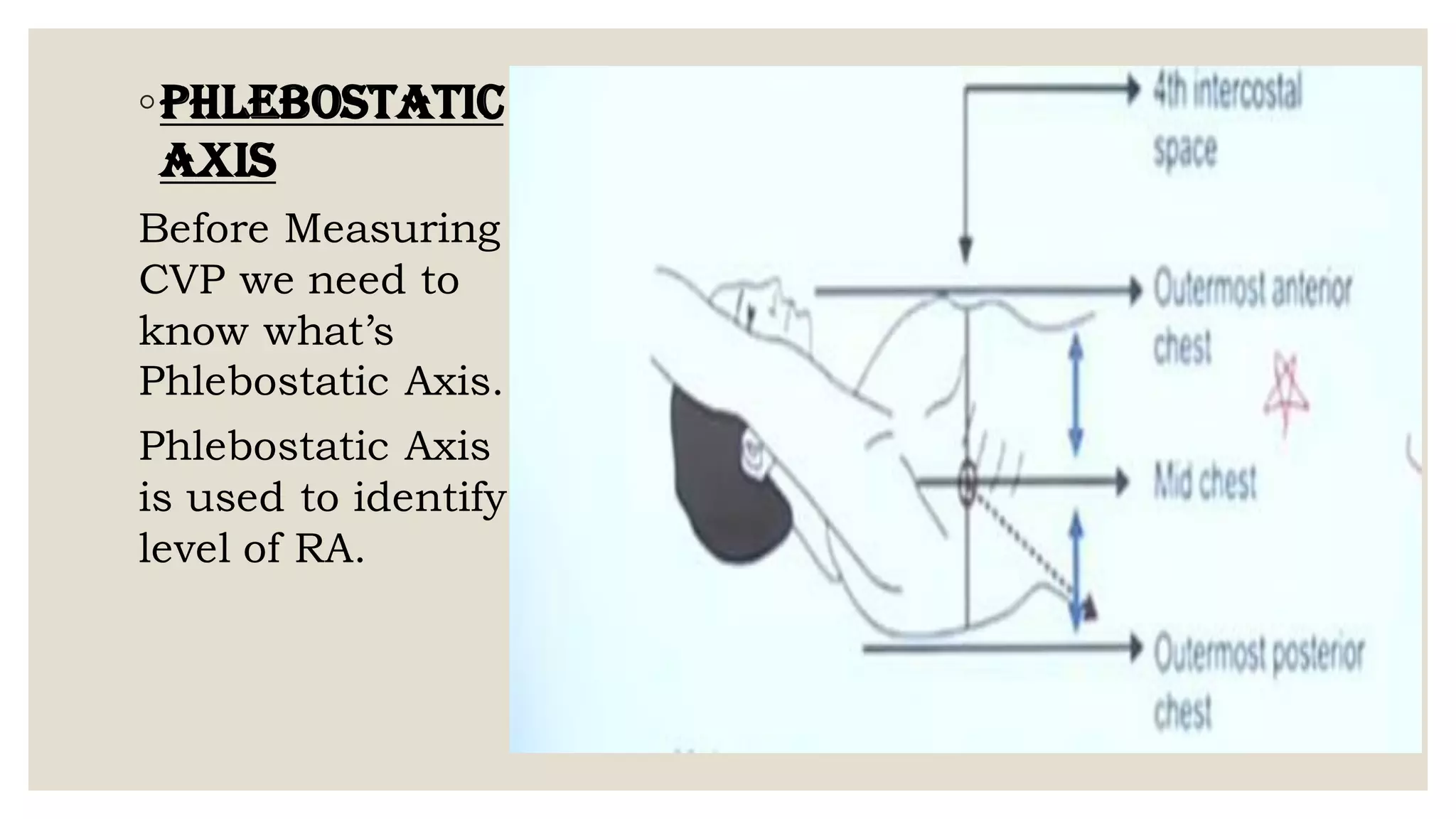 cvp monitoring | PDF