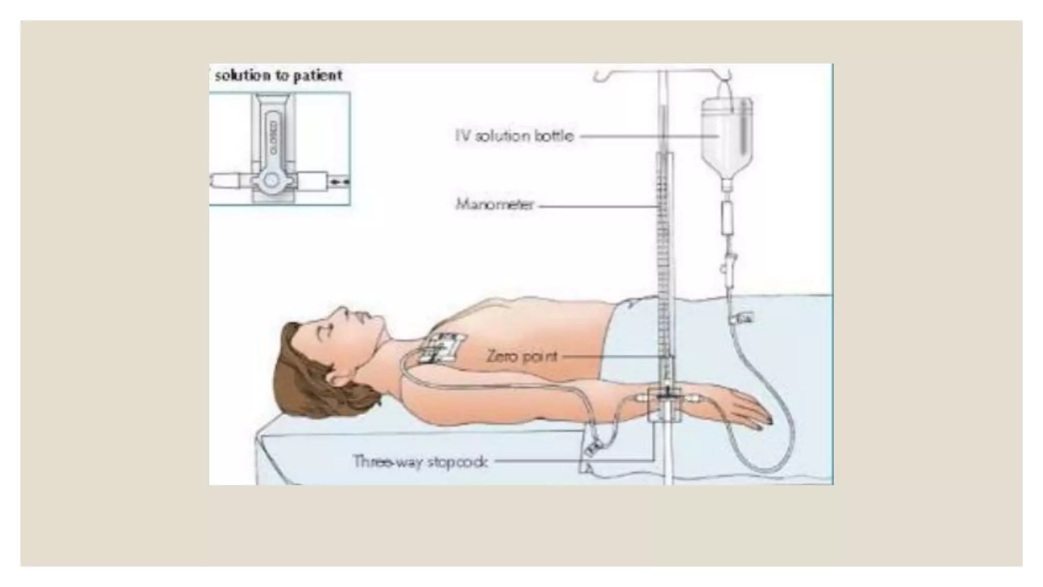 cvp monitoring | PDF