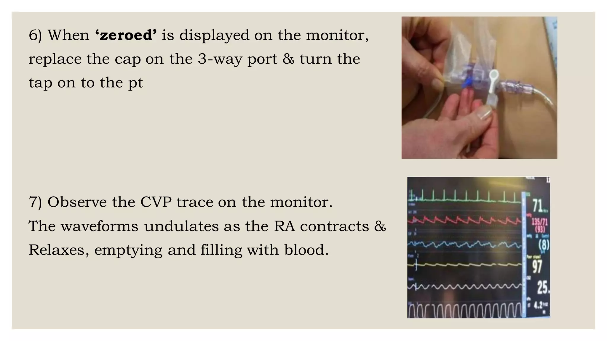 cvp monitoring | PDF