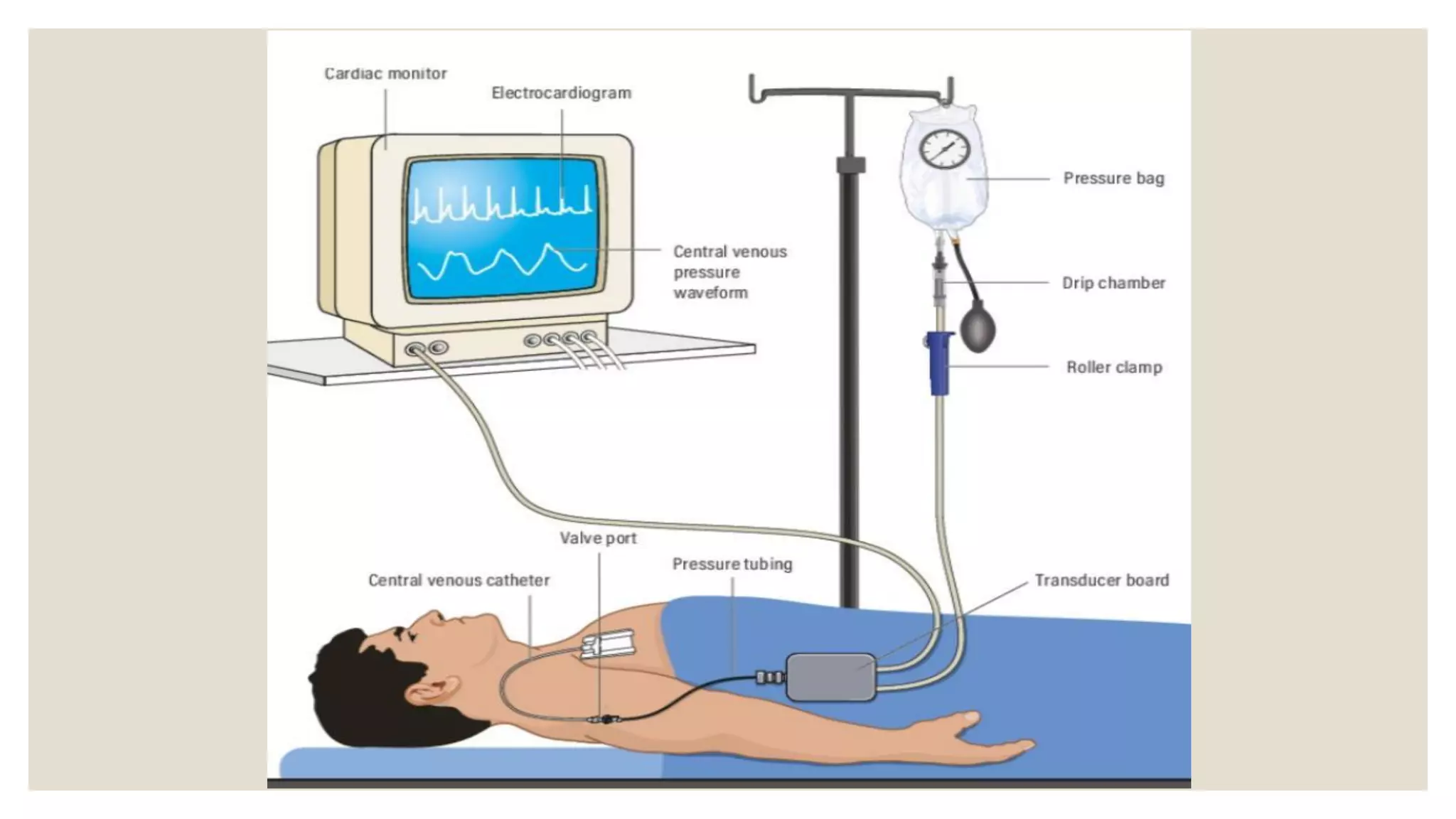 cvp monitoring | PDF