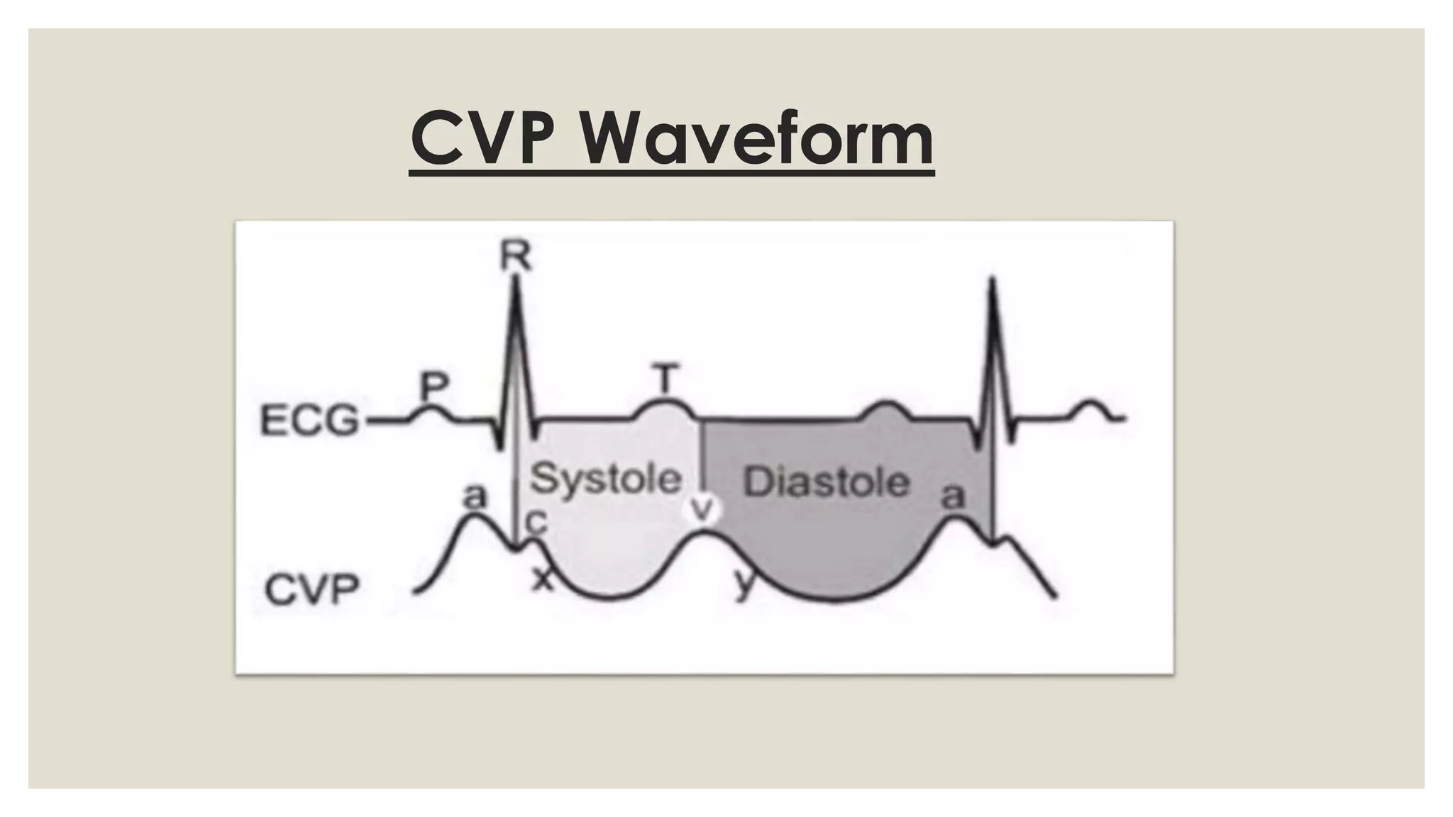 cvp monitoring | PDF
