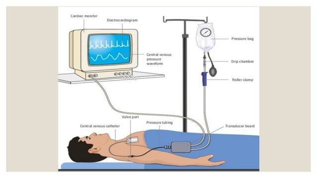 cvp monitoring | PDF