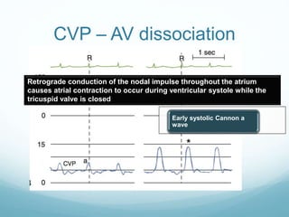 CVP Pulmonary artery wedge pressure monitoring: Physiology | PPT