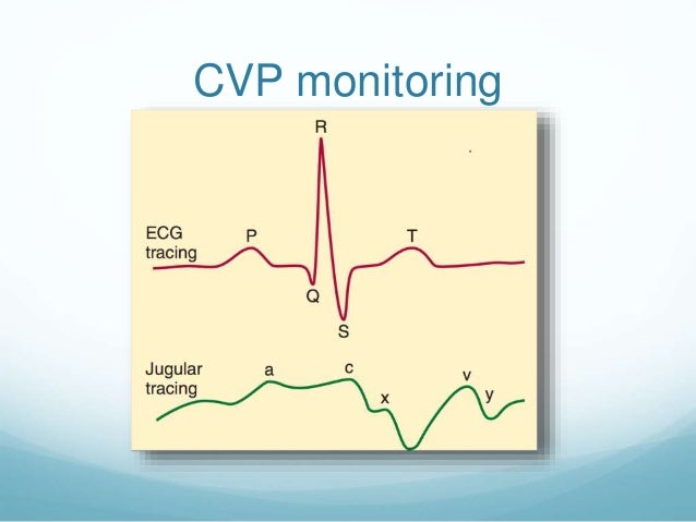 CVP Pulmonary artery wedge pressure monitoring: Physiology