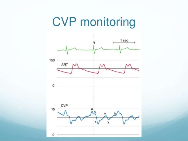 CVP Pulmonary artery wedge pressure monitoring: Physiology