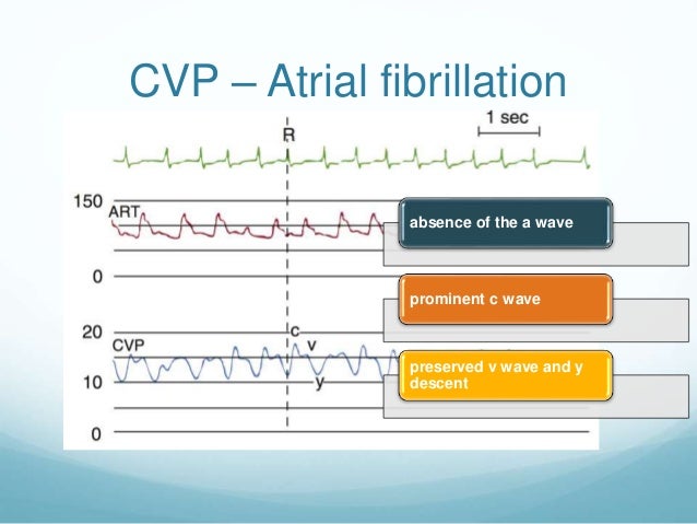 CVP Pulmonary artery wedge pressure monitoring: Physiology