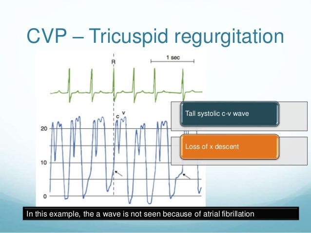 CVP Pulmonary artery wedge pressure monitoring: Physiology