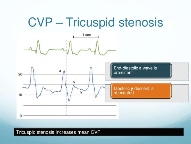 CVP Pulmonary artery wedge pressure monitoring: Physiology