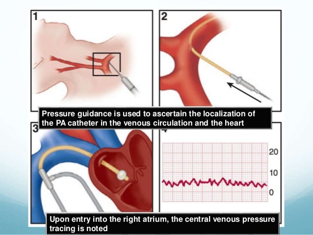 CVP Pulmonary artery wedge pressure monitoring: Physiology