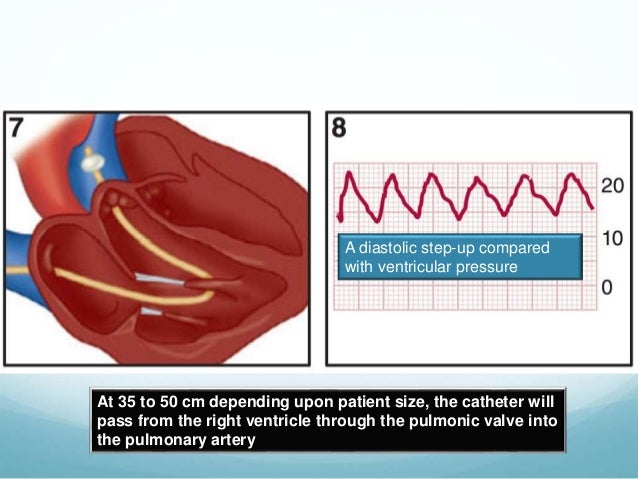 CVP Pulmonary artery wedge pressure monitoring: Physiology