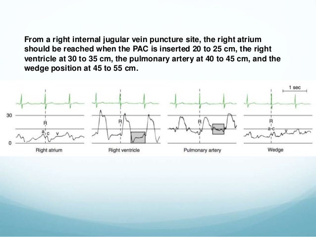 CVP Pulmonary artery wedge pressure monitoring: Physiology