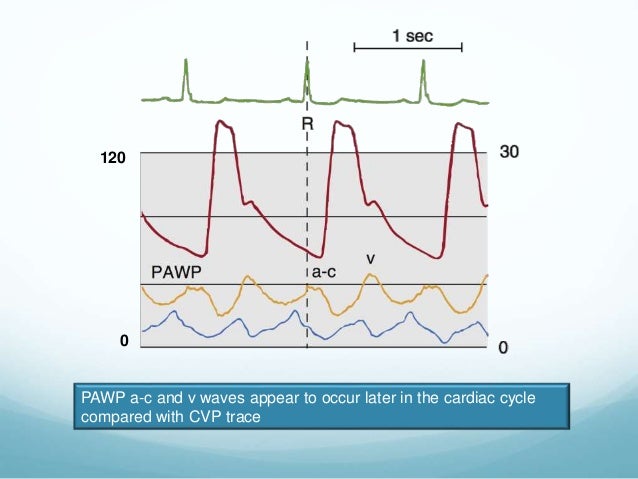 CVP Pulmonary artery wedge pressure monitoring: Physiology