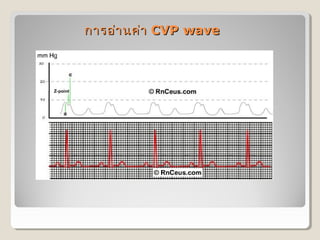 Cvp central venous pressure monitoring | PPT