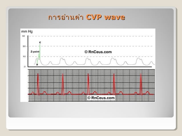 Cvp central venous pressure monitoring | PPT
