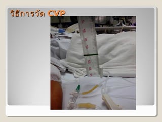 Cvp central venous pressure monitoring | PPT