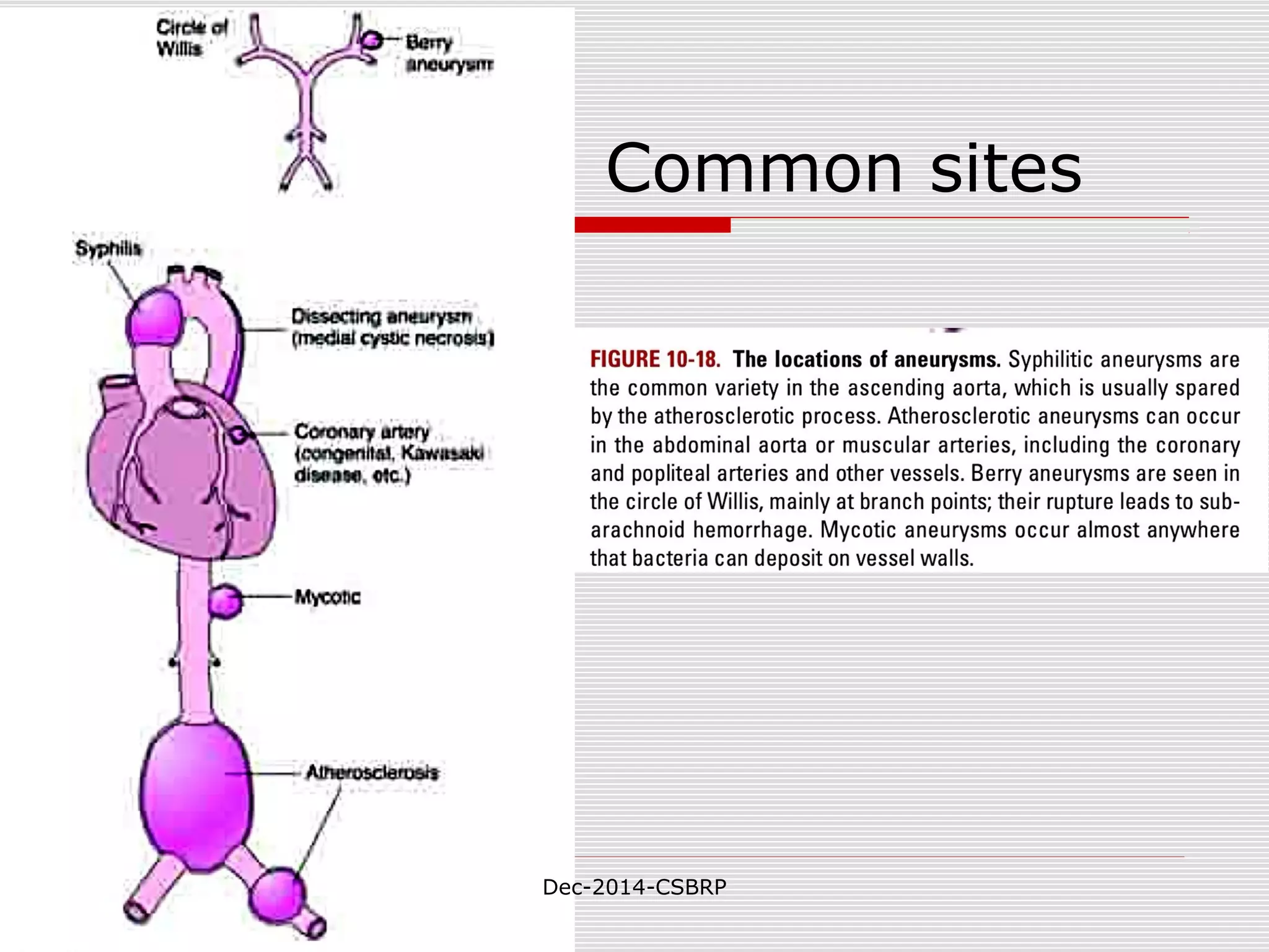 Cvs aneurysms&dissection-csbrp | PPT