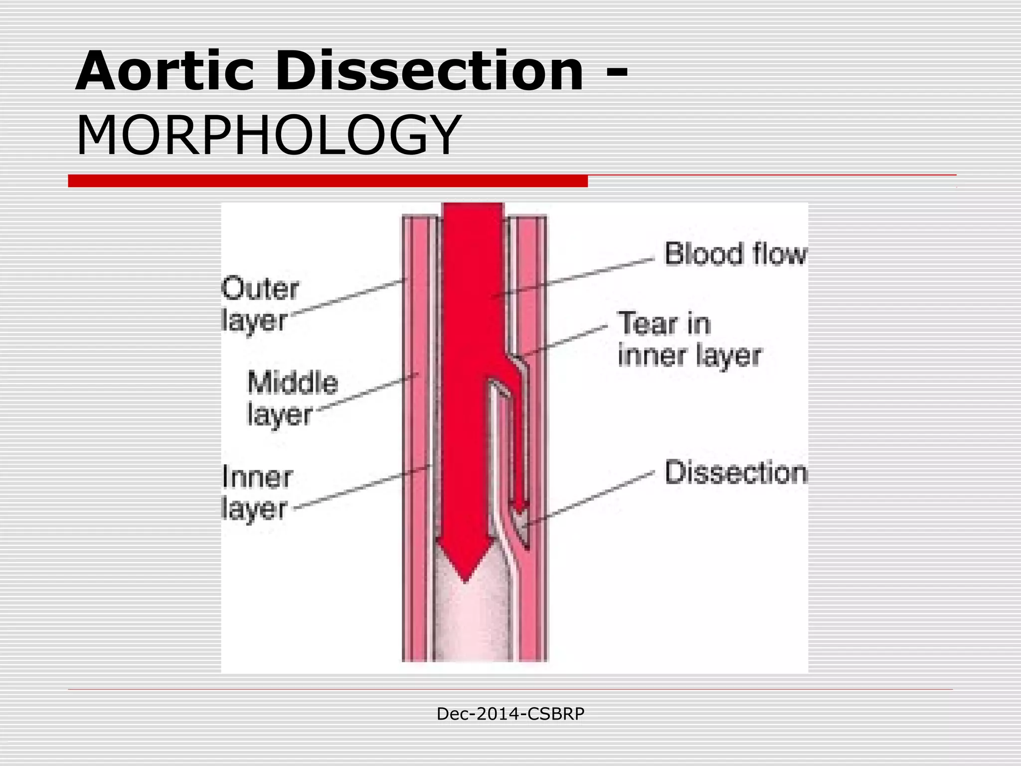 Cvs aneurysms&dissection-csbrp | PPT