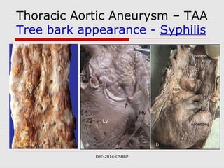Tree Bark Aorta