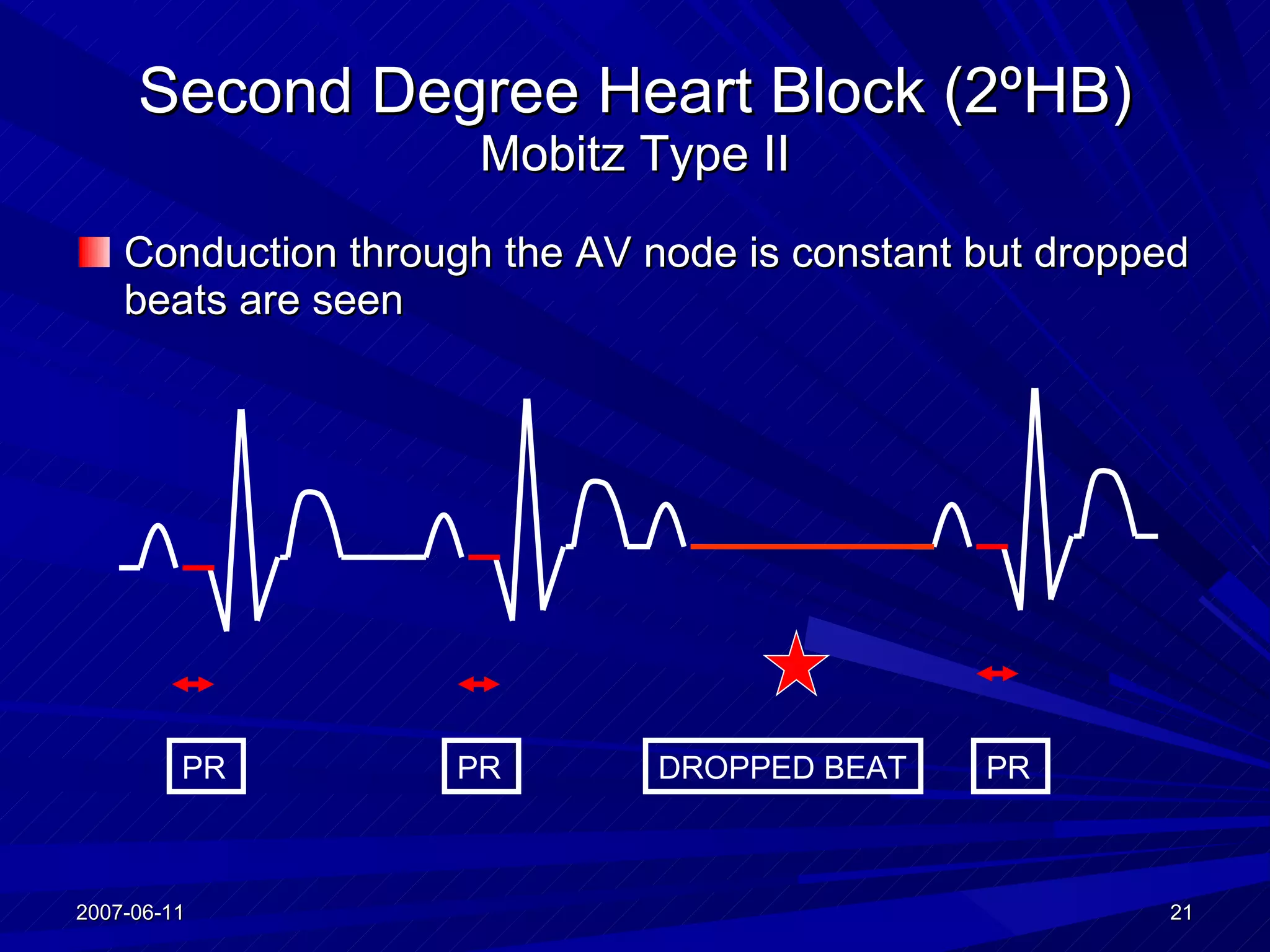 AV Nodal Blocks | PPT